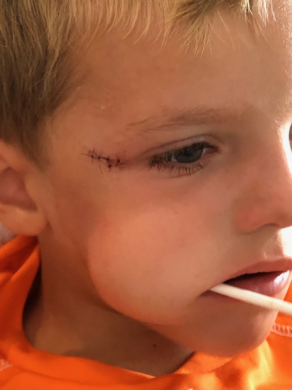 Broken Elbow and More Travel During the Pandemic (part 2) | Follow the ...